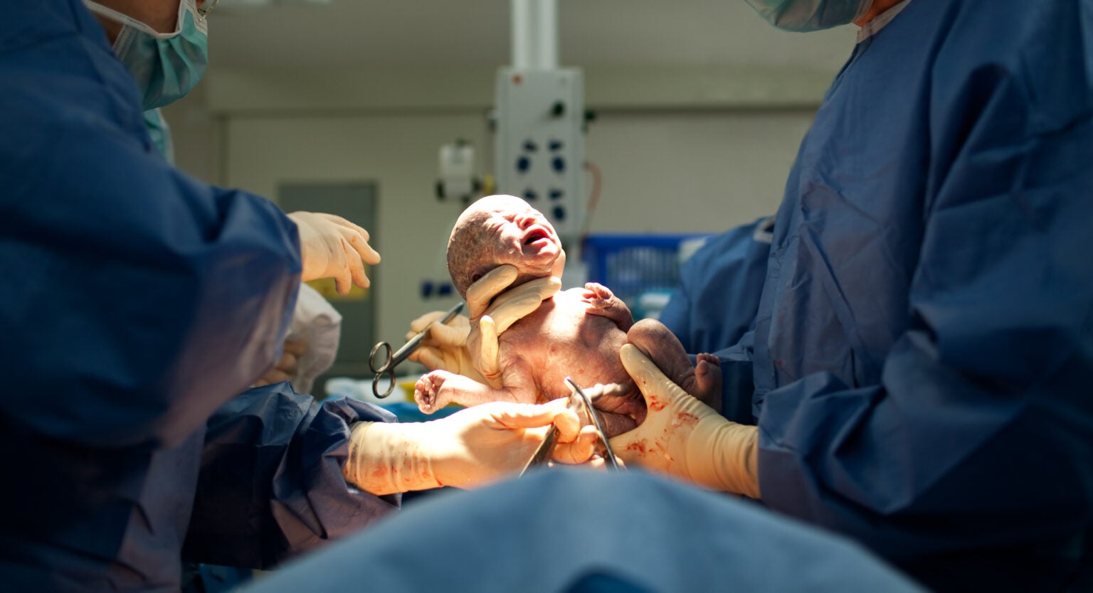 Study tracks long-term health risks to women after having a C-section ...